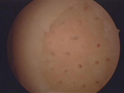 Wrist Arthritis: Arthroscopic Techniques of Synovectomy, Abrasion ...