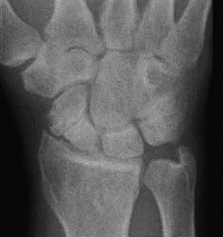 Wrist Arthritis: Arthroscopic Techniques of Synovectomy, Abrasion ...