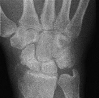 Wrist Arthritis: Arthroscopic Techniques of Synovectomy, Abrasion ...