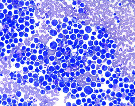 Lymphocytic Effusions | SpringerLink