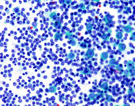 Lymphocytic Effusions | SpringerLink