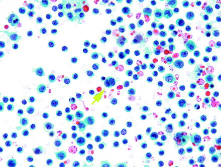 Lymphocytic Effusions | SpringerLink