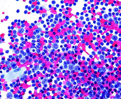 Lymphocytic Effusions | SpringerLink