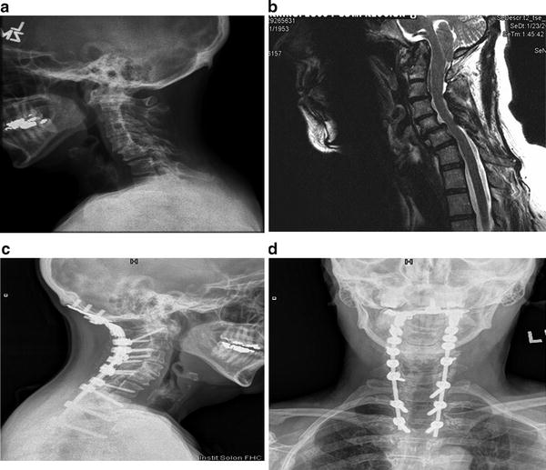 Cervical Spine Stabilization | SpringerLink