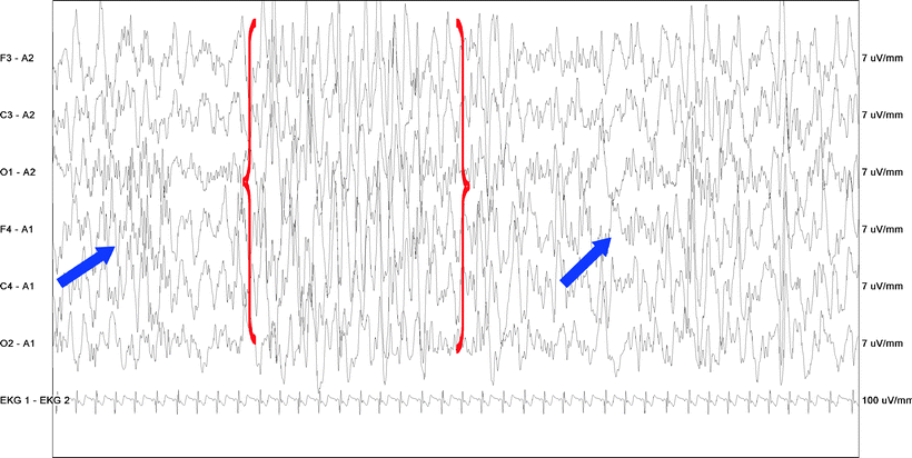 Normal Electroencephalography Variants In Sleep Springerlink