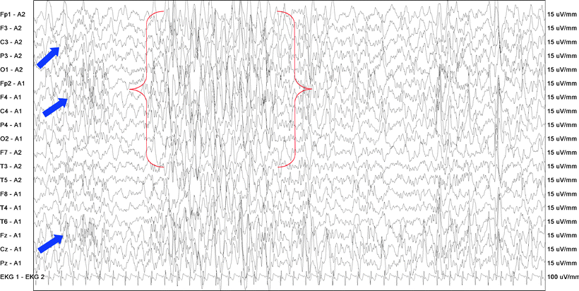 Normal Electroencephalography Variants in Sleep | SpringerLink