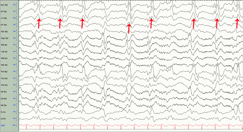 Epileptiform Abnormalities | SpringerLink
