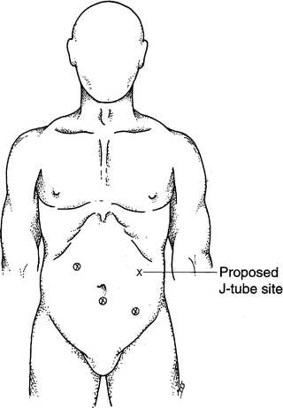 29. Laparoscopic Placement of Jejunostomy Tube | SpringerLink