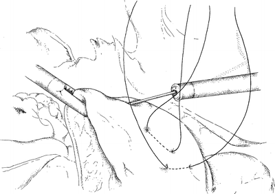 29. Laparoscopic Placement of Jejunostomy Tube | SpringerLink