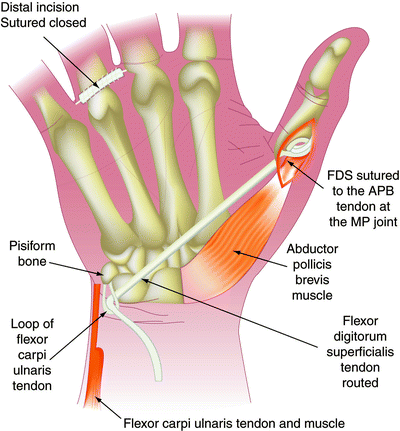 Secondary Procedures for Failed Tendon Transfers | SpringerLink