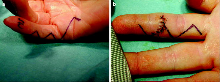 Options for Failed Flexor Tendon Surgery | SpringerLink