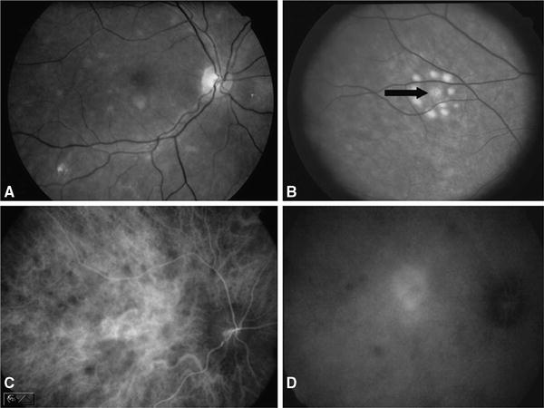 Diffuse Unilateral Subacute Neuroretinitis (DUSN) | SpringerLink