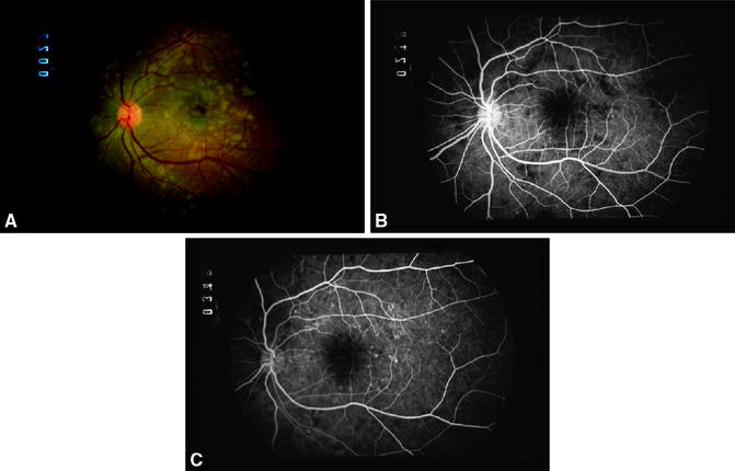 Retinal and Choroidal Manifestations of Systemic Hypertension ...