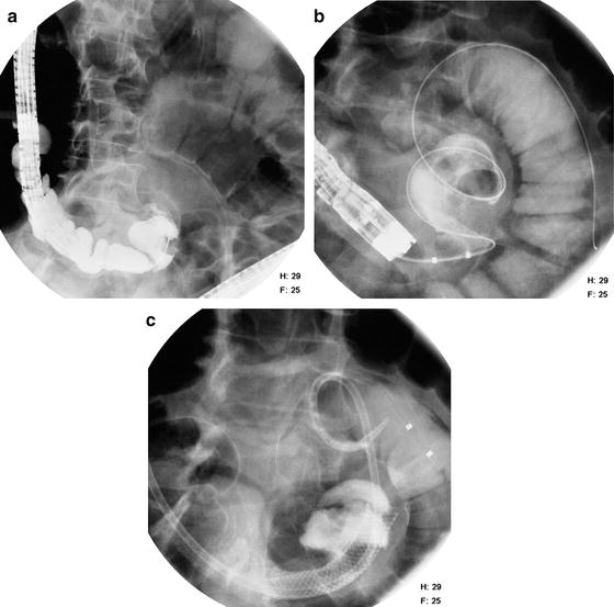 Enteric Stents: Indications and Placement Techniques | SpringerLink
