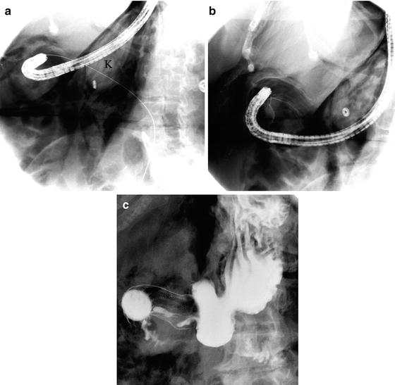 Enteric Stents: Indications and Placement Techniques | SpringerLink