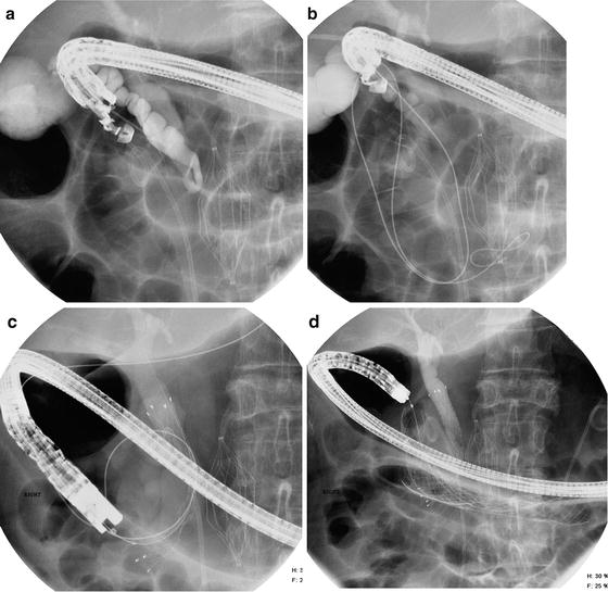 Enteric Stents: Indications and Placement Techniques | SpringerLink