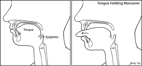 Mendelson Maneuver and Masako Maneuver | SpringerLink