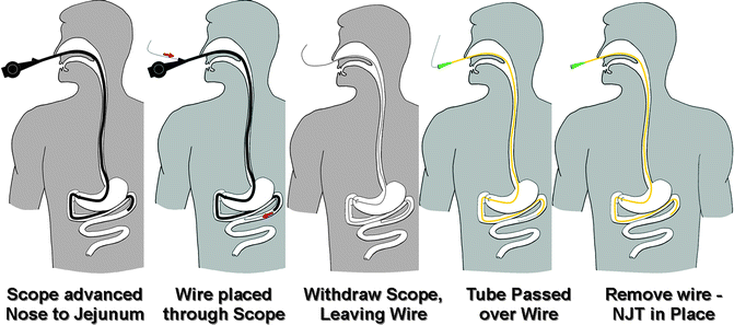 Miller Abbott Tube The Miller Abbott Tube : Two Complications In Its