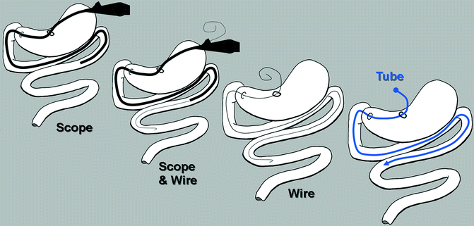 Tube Feeding: Indications, Considerations, and Technique | SpringerLink