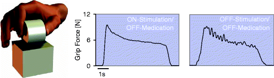 Isometric Tremor | SpringerLink