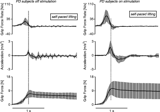 Isometric Tremor | SpringerLink