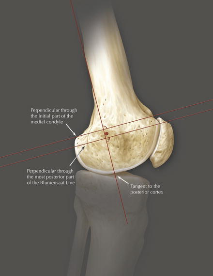 MPFL Repair and Reconstruction | SpringerLink