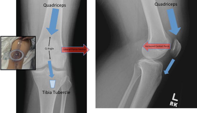 Tibial Tubercle Osteotomies | SpringerLink