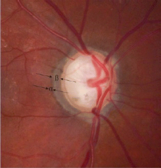 Clinical Examination of the Optic Nerve | SpringerLink