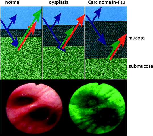 Autofluorescence Bronchoscopy and Narrow Band Imaging | SpringerLink