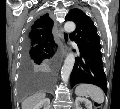 Pleurodesis | SpringerLink