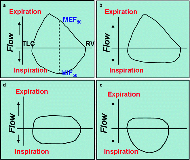 Physiology of Fixed Airway Obstruction | SpringerLink
