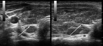Ultrasound of Diffuse Thyroid Enlargement: Thyroiditis | SpringerLink