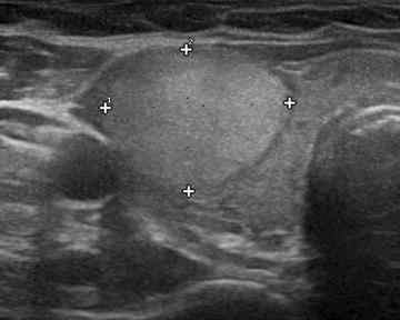 Ultrasound of Diffuse Thyroid Enlargement: Thyroiditis | SpringerLink