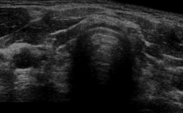 Ultrasound of Diffuse Thyroid Enlargement: Thyroiditis | SpringerLink