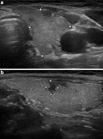 Ultrasound of Diffuse Thyroid Enlargement: Thyroiditis | SpringerLink
