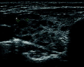 Ultrasound of Diffuse Thyroid Enlargement: Thyroiditis | SpringerLink