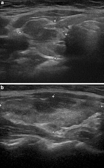 Ultrasound of Diffuse Thyroid Enlargement: Thyroiditis | SpringerLink
