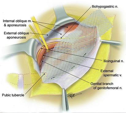 Technique: Lichtenstein | SpringerLink