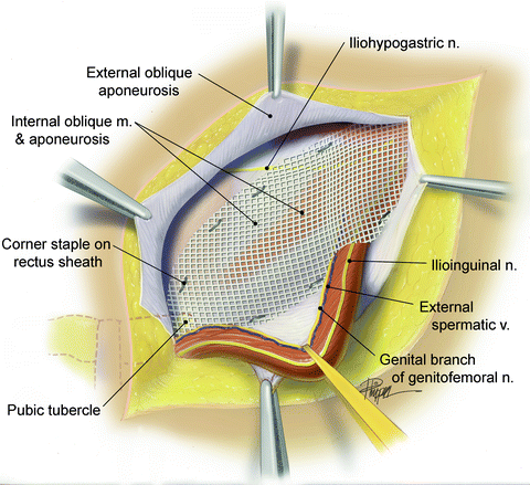 Lichtenstein Tensionfree Open Inguinal Hernia Repair
