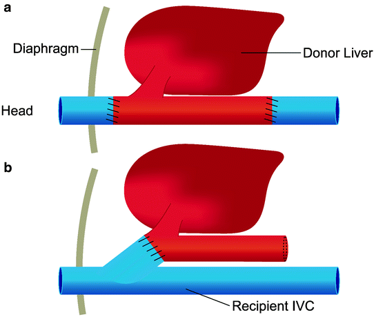 Caval Cross-Clamping, Piggyback, and Veno-Venous Bypass | SpringerLink