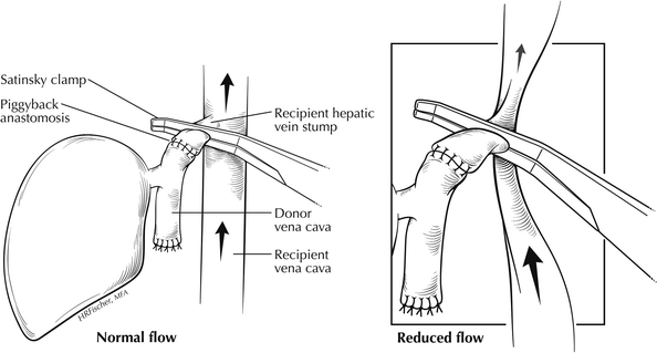 Caval Cross-Clamping, Piggyback, and Veno-Venous Bypass | SpringerLink