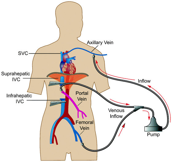 Caval Cross-Clamping, Piggyback, and Veno-Venous Bypass | SpringerLink
