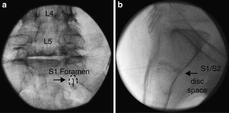 Interventional Pain Management | SpringerLink