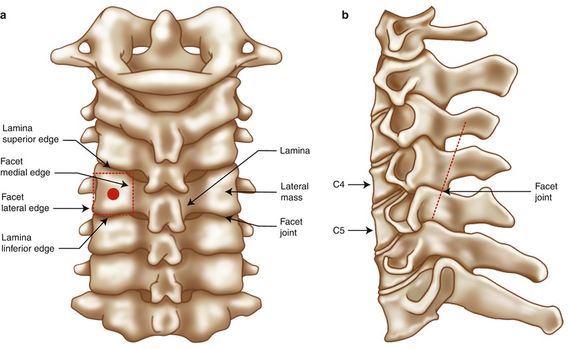 Minimally Invasive Posterior Cervical Fusion | SpringerLink