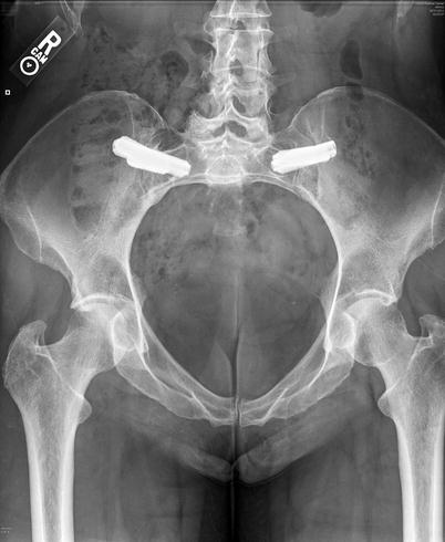 The Painful Sacroiliac Iliac Joint | SpringerLink