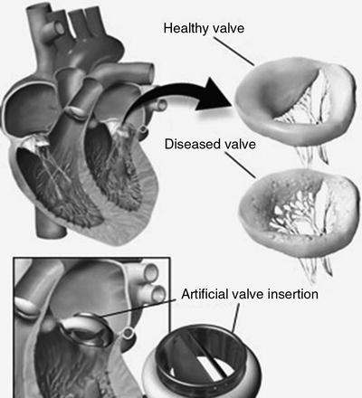 The Design of Heart Valves | SpringerLink