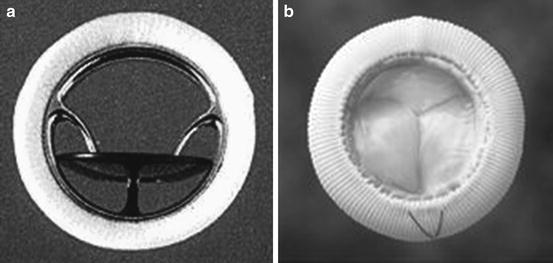 The Design of Heart Valves | SpringerLink