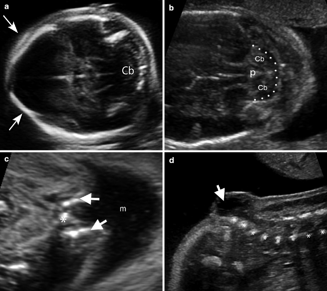 Radiology of the Chiari Malformations | SpringerLink