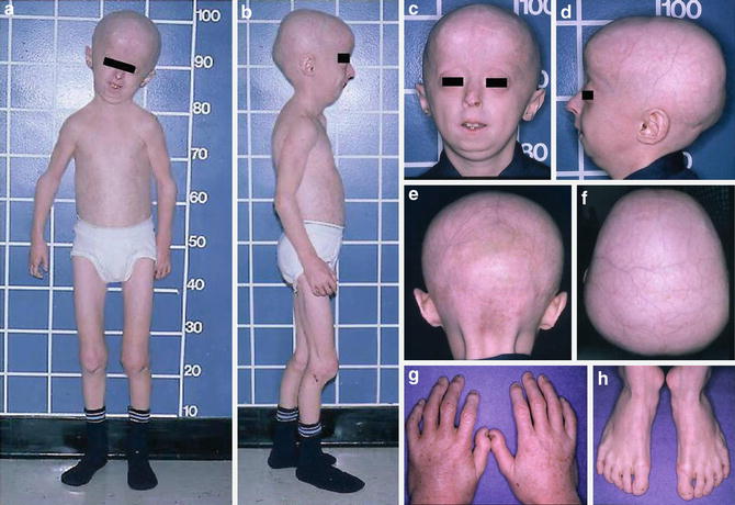 Progeria | SpringerLink