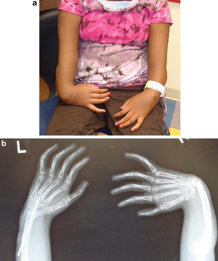 Thrombocytopenia-Absent Radius Syndrome | SpringerLink